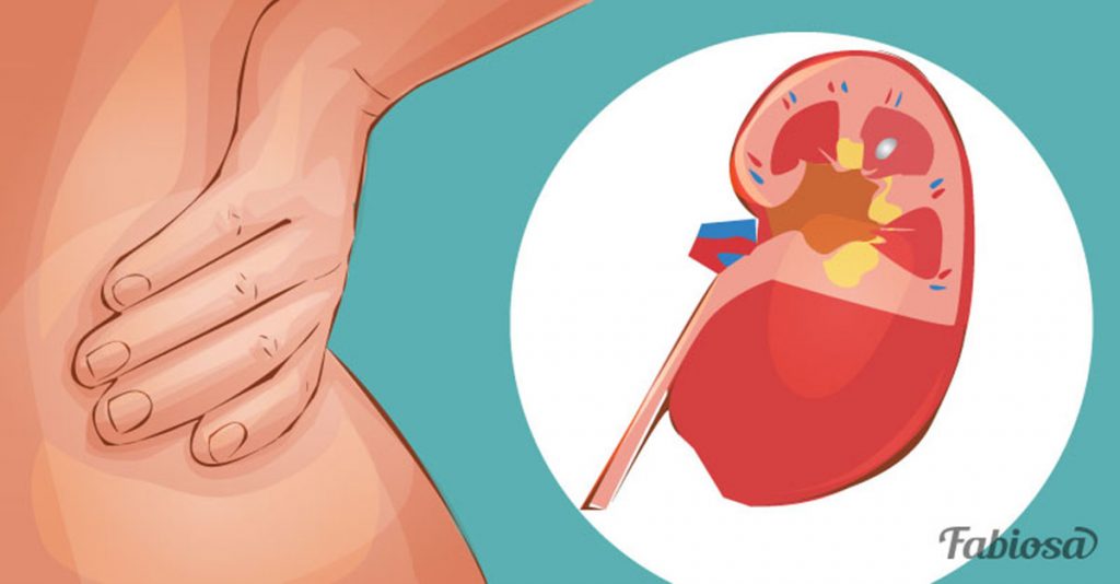 Cómo Evitar Y Tratar El Cólico Renal Que Para Muchos Es el Peor Dolor ...