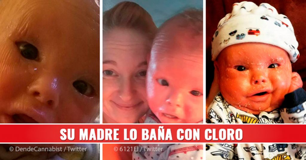 Su Hijo Nació Con Síndrome De Arlequín Debe Lijar Su Piel Y Darle