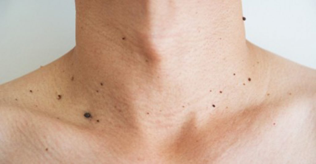 Por Qué Se Originan Los Acrocordones Y Cómo Eliminarlos | Circulo Social